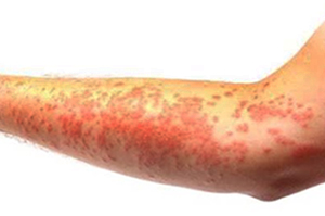 Ekzém - prírodné riešenie z bylinkových extraktov | HillVital